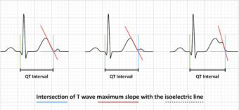 QT Interval • LITFL • ECG Library Basics