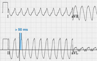 R Wave Peak Time RWPT • LITFL • ECG Library Diagnosis