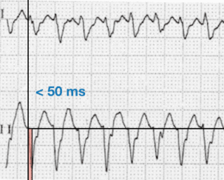 R Wave Peak Time RWPT • LITFL • ECG Library Diagnosis