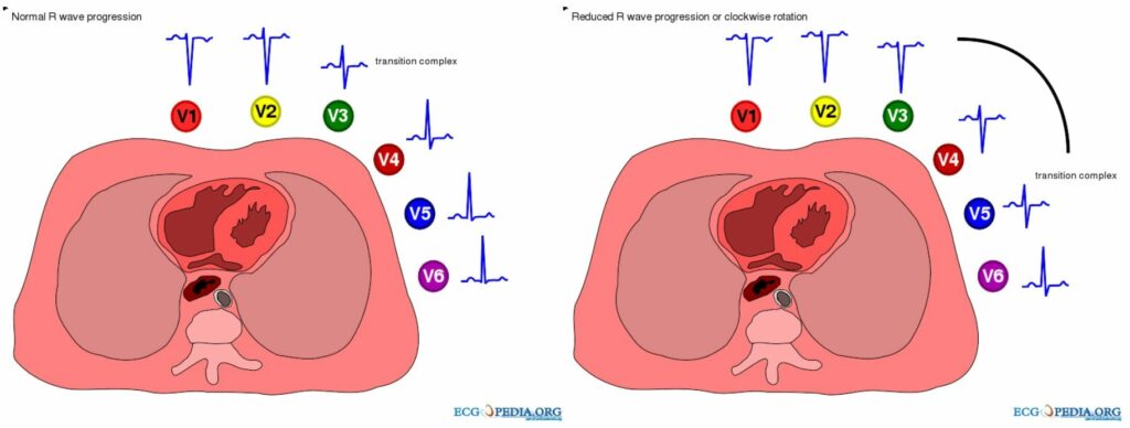 ECG in Chronic Obstructive Pulmonary Disease • LITFL • ECG Library