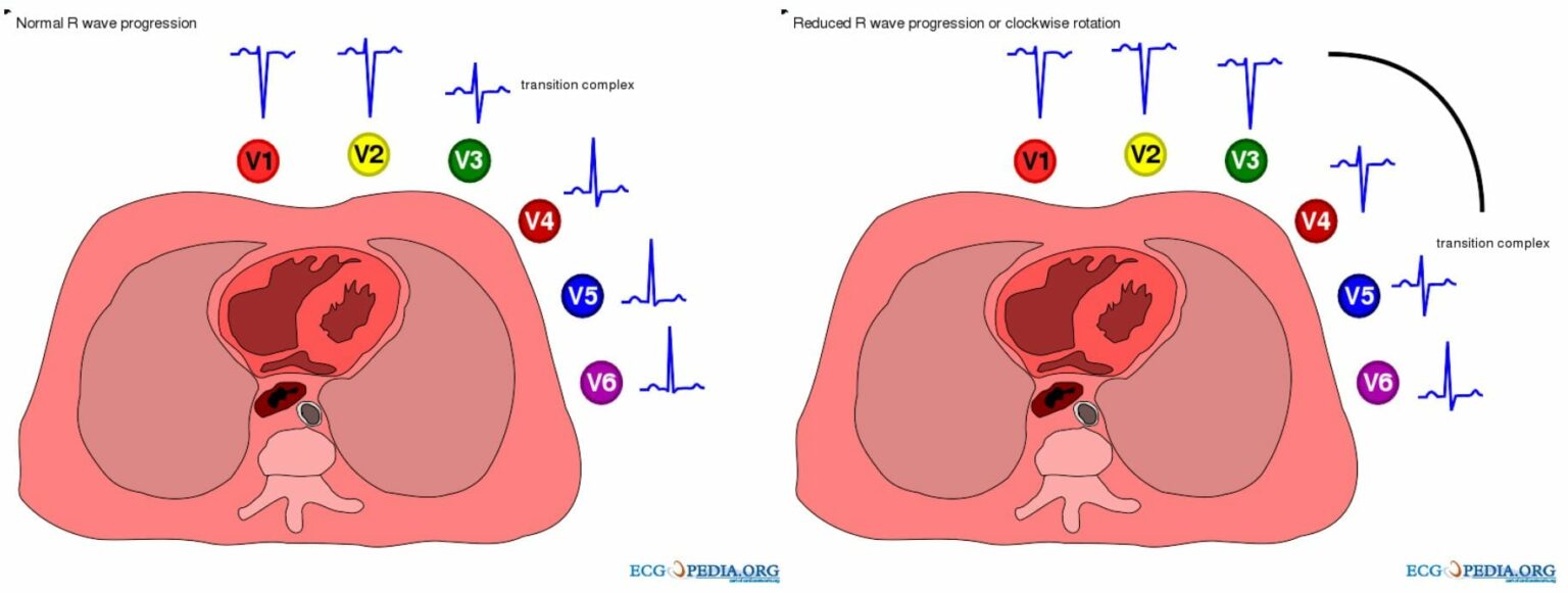 ECG in Chronic Obstructive Pulmonary Disease • LITFL • ECG Library