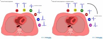 ECG in Chronic Obstructive Pulmonary Disease • LITFL • ECG Library