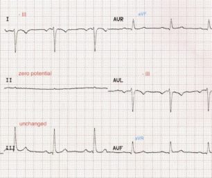 ECG Limb Lead Reversal • LITFL • ECG Library Diagnosis