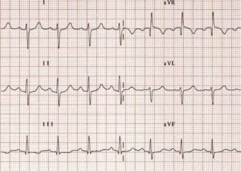 ECG Axis Interpretation • LITFL • ECG Library Basics