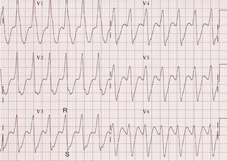 VT versus SVT • LITFL Medical Blog • ECG Library Basics