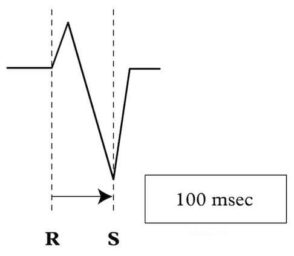 VT versus SVT • LITFL Medical Blog • ECG Library Basics