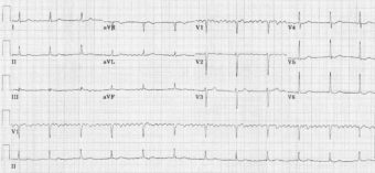 Digoxin Toxicity • LITFL • ECG Library Toxicology