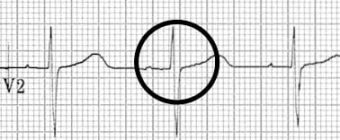 Supraventricular Tachycardia (SVT) • LITFL • ECG Library Diagnosis