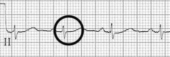 Supraventricular Tachycardia (SVT) • LITFL • ECG Library Diagnosis