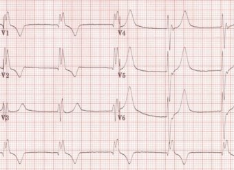 R wave • LITFL • ECG Library Basics