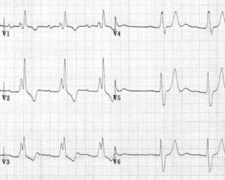 T wave • LITFL • ECG Library Basics