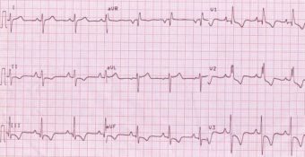 T wave • LITFL • ECG Library Basics