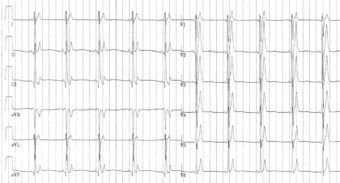 Short QT Syndrome • LITFL • ECG Library Diagnosis