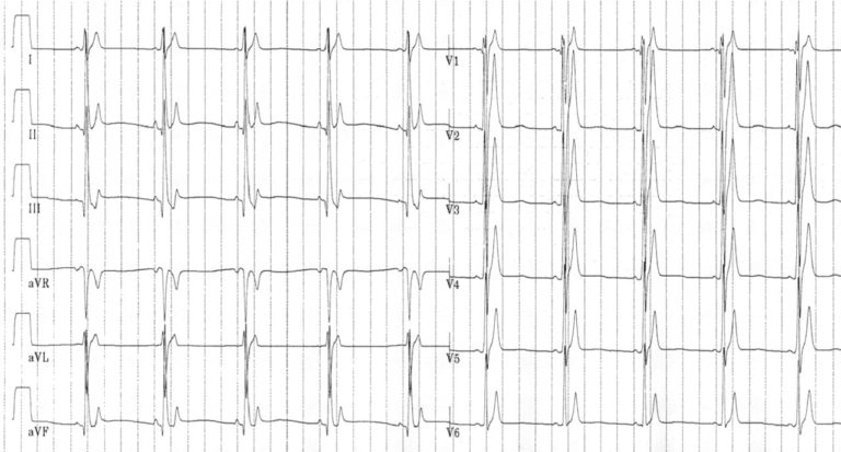 Short QT Syndrome • LITFL • ECG Library Diagnosis