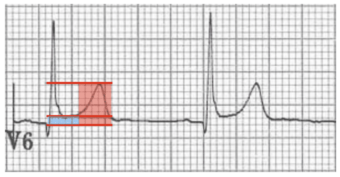 Benign Early Repolarisation • LITFL • ECG Library Diagnosis