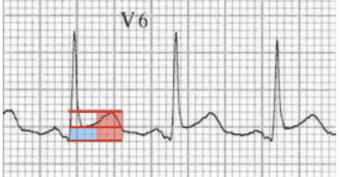 Benign Early Repolarisation • LITFL • ECG Library Diagnosis