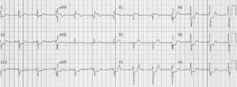 ST Elevation in aVR • LITFL • ECG Library Diagnosis