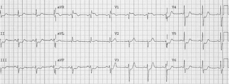 ST Elevation in aVR • LITFL • ECG Library Diagnosis