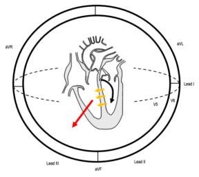Right Bundle Branch Block (RBBB) • LITFL • ECG Library Diagnosis