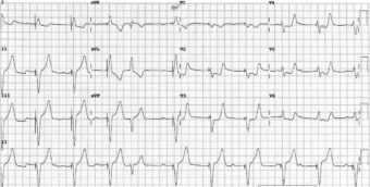 Sgarbossa Criteria • LITFL • ECG Library Diagnosis