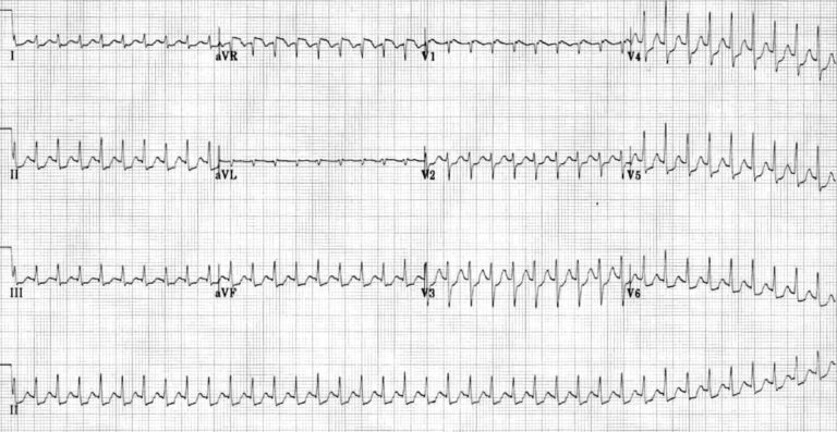 Supraventricular Tachycardia (SVT) • LITFL • ECG Library Diagnosis