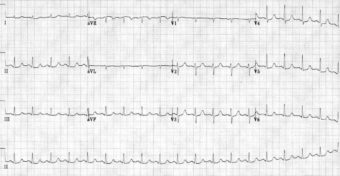 Supraventricular Tachycardia (SVT) • LITFL • ECG Library Diagnosis