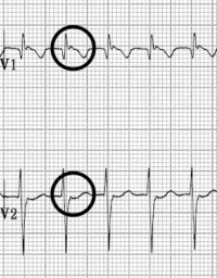 Supraventricular Tachycardia (SVT) • LITFL • ECG Library Diagnosis