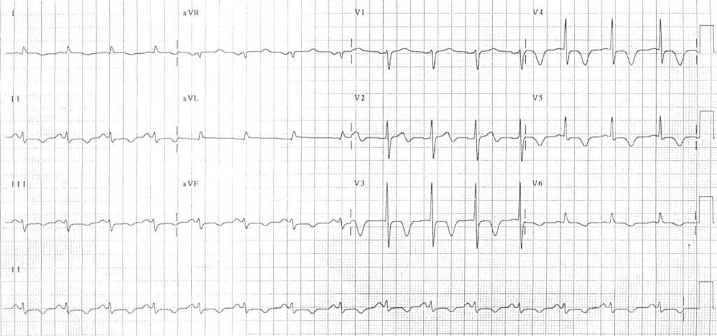 Raised Intracranial Pressure ECG Changes • LITFL • ECG Library Raised Intracranial Pressure ECG Changes • LITFL • ECG Library