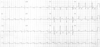 Raised Intracranial Pressure ECG Changes • LITFL • ECG Library