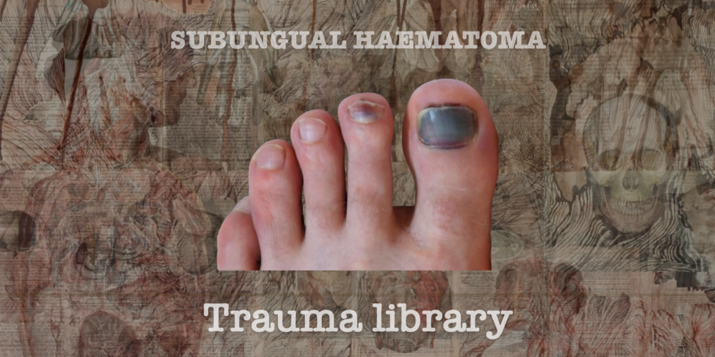 Subungual haematoma • LITFL • Clinical Cases Bamboozler