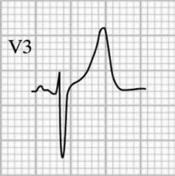 Benign Early Repolarisation • LITFL • ECG Library Diagnosis
