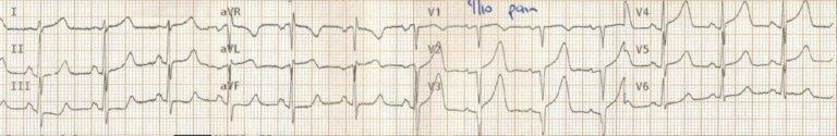 Wellens Syndrome • LITFL • ECG Library Eponym