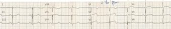 Wellens Syndrome • LITFL • ECG Library Eponym