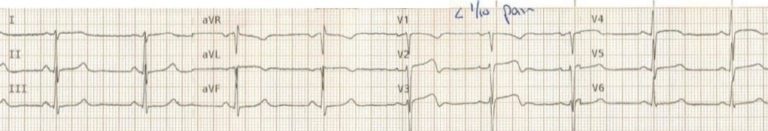 Wellens Syndrome • LITFL • ECG Library Eponym