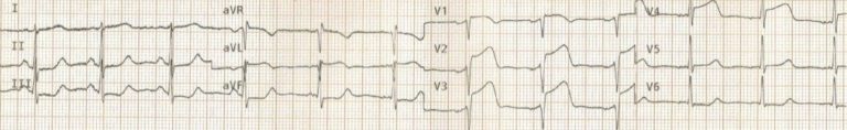 ECG Case 005 • LITFL • ECG Top 100 Self-Assessment Quiz