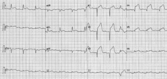 ECG Case 009 • LITFL • ECG Top 100 Self-Assessment Quiz