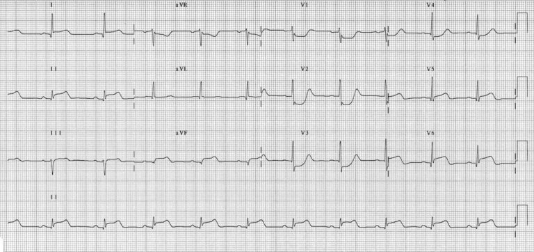 ECG Case 014 • LITFL • ECG Top 100 Self-Assessment Quiz