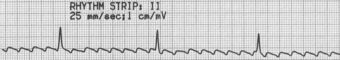 ECG Case 018 • LITFL • ECG Top 100 Self-Assessment Quiz