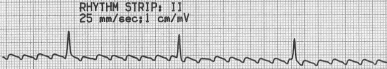 ECG Case 018 • LITFL • ECG Top 100 Self-Assessment Quiz