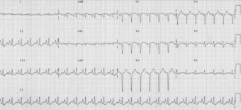 ECG Case 021 • LITFL • ECG Top 100 Self-Assessment Quiz