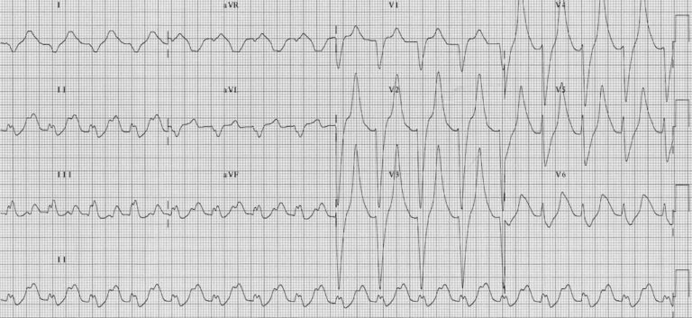 ECG Case 027 • LITFL • ECG Top 100 Self-Assessment Quiz