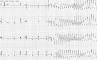 ECG Case 031 • LITFL • ECG Top 100 Self-Assessment Quiz