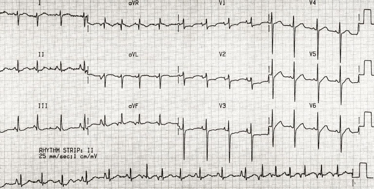 ECG Case 033 • LITFL • ECG Top 100 Self-Assessment Quiz