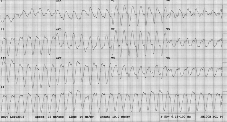 ECG Case 047 • LITFL • ECG Top 100 Self-Assessment Quiz