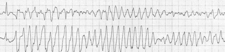 Common paediatric arrhythmias • LITFL • ECG Library Diagnosis