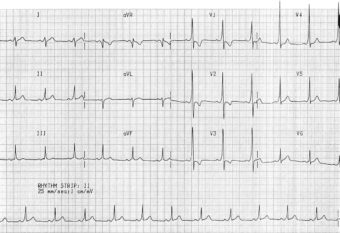 Pre-excitation syndromes • LITFL • ECG Library Diagnosis