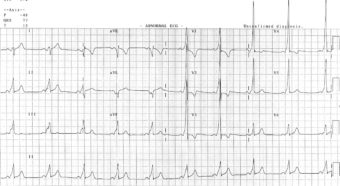 Pre-excitation syndromes • LITFL • ECG Library Diagnosis