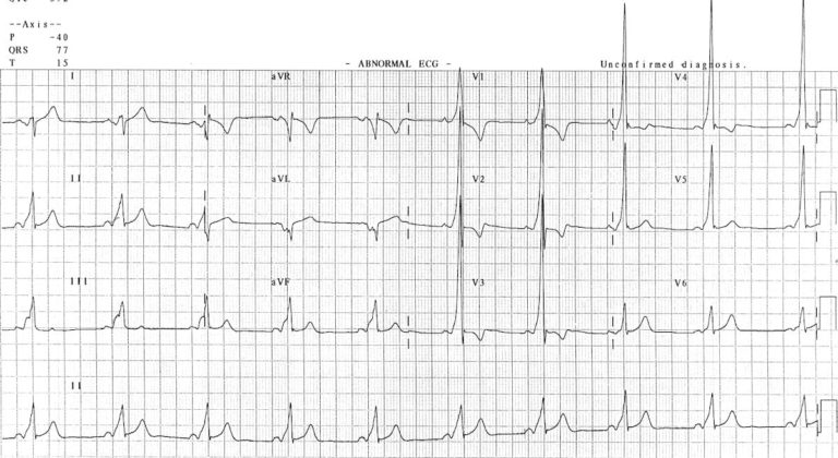 Pre-excitation syndromes • LITFL • ECG Library Diagnosis