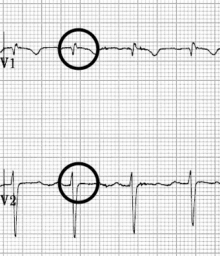 Supraventricular Tachycardia (SVT) • LITFL • ECG Library Diagnosis