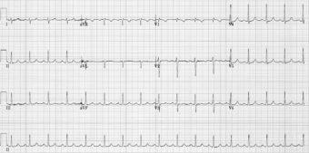Supraventricular Tachycardia (SVT) • LITFL • ECG Library Diagnosis